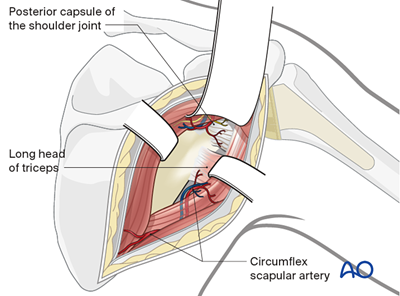 Posterior approach to the scapular body