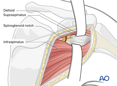 Posterior approach to the scapular body