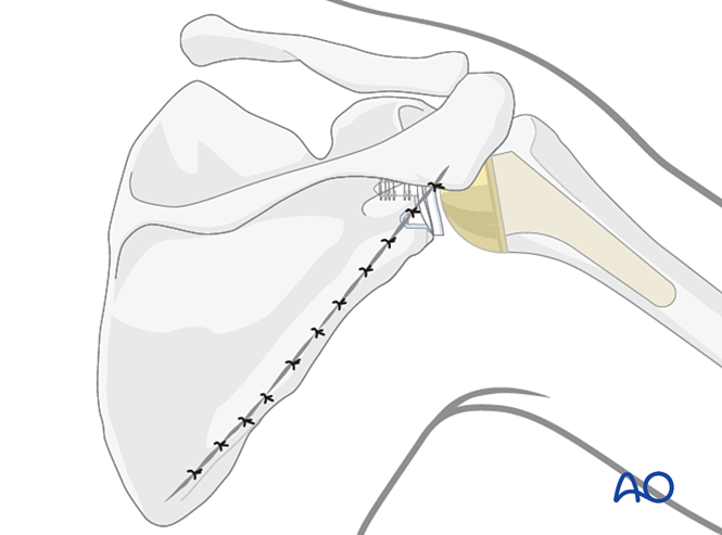 Posterior approach to the scapular body