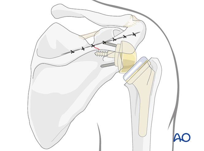 Extended superior scapular approach