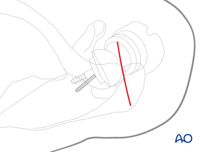 Superior acromial anterior to posterior approach (Sabercut approach)