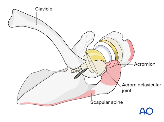 Superior scapular approach