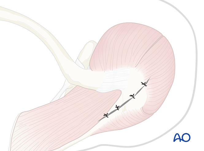 Superior scapular approach