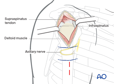 All approaches to the shoulder