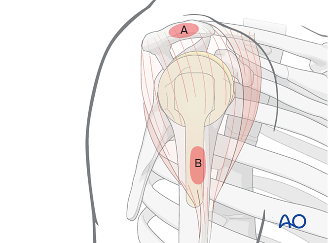 Deltoid split approach