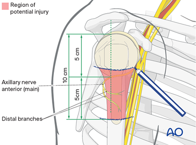 Deltoid split approach