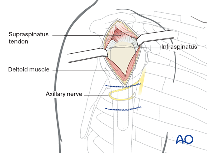Deltoid split approach