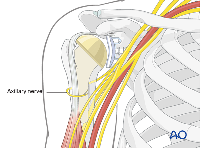 Deltoid split approach