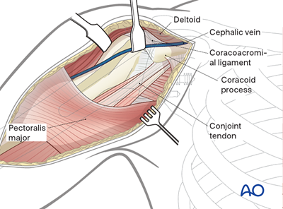 Deltopectoral approach