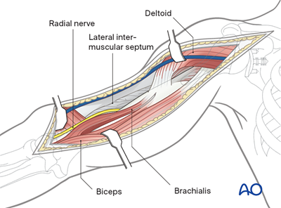 Deltopectoral approach