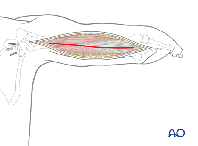 Posterior humeral approach