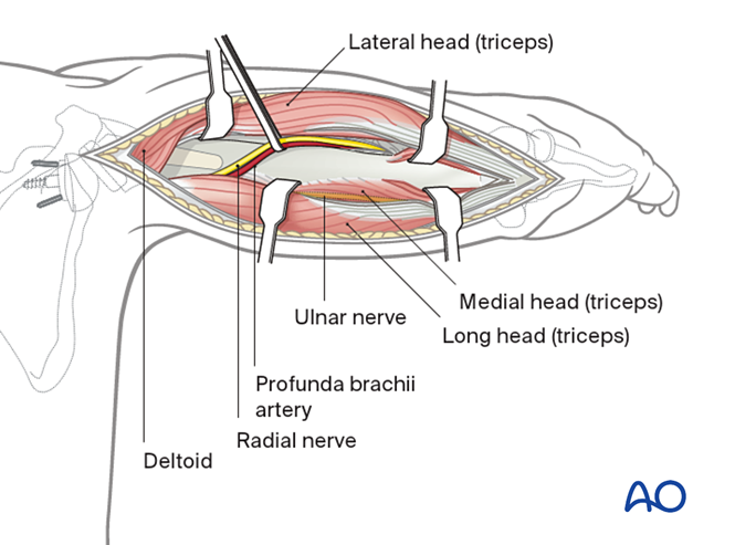 Posterior humeral approach