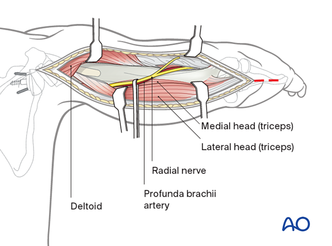 Posterior humeral approach