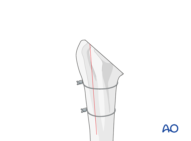 Humeral osteotomy