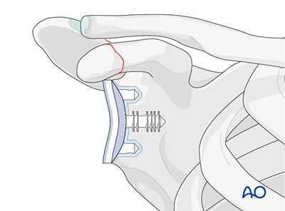 Avulsion of the coracoid process