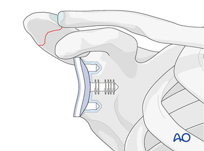 Avulsion of the acromion
