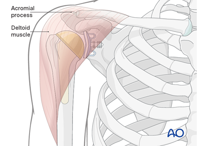 Avulsion of the acromion