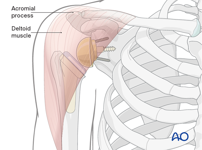 Avulsion of the acromion