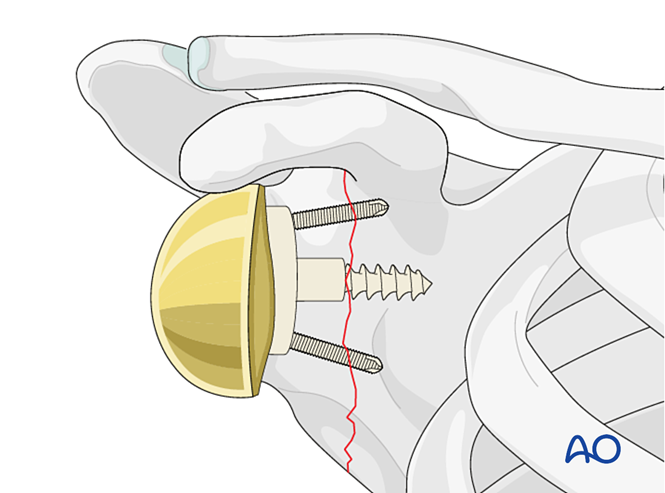 Glenoid implant stable, good bone