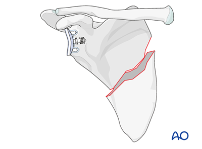 Body of the scapula