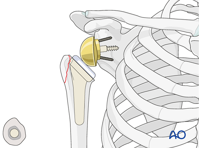 Avulsion of the greater tuberosity