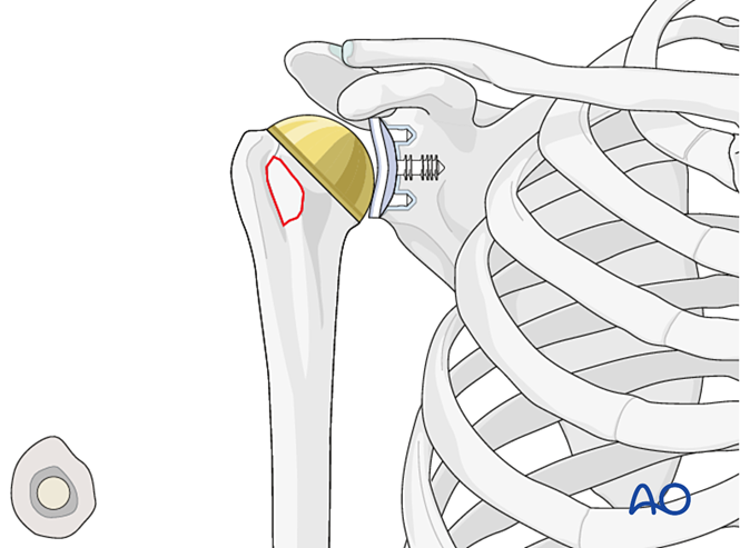 Avulsion of the lesser tuberosity