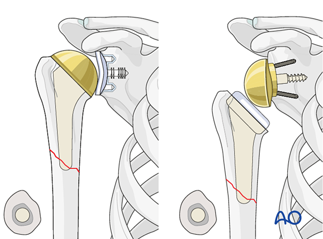 Humeral implant stable, good bone