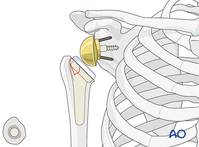 Avulsion of the lesser tuberosity