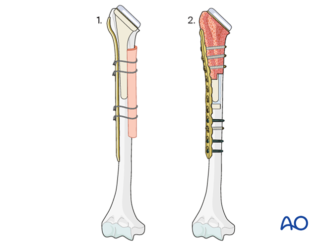 Bony reconstruction with augmentation in the proximal humerus