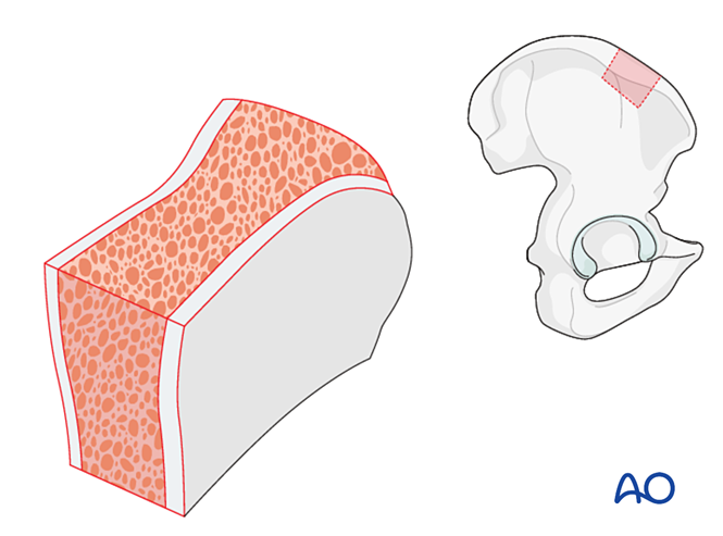Bony reconstruction with augmentation for Fracture type