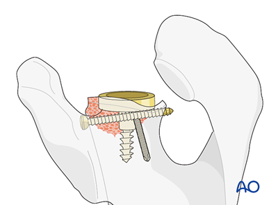 Bony reconstruction with augmentation in the glenoid