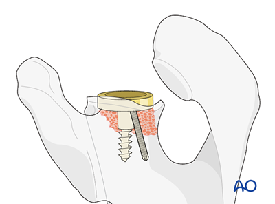 Bony reconstruction with augmentation for Fracture type
