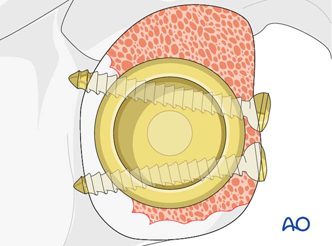 Bony reconstruction with augmentation in the glenoid