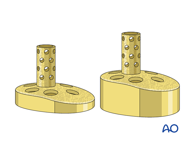 Bony reconstruction with augmentation for Fracture type