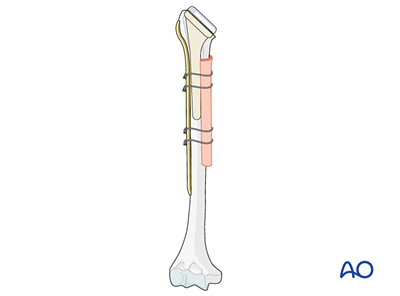 Bony reconstruction with augmentation for