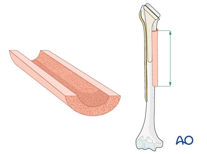 Bony reconstruction with augmentation for