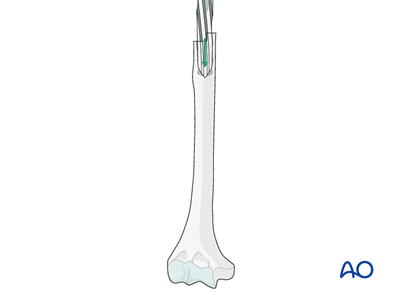 Humeral revision with allograft for Humeral implant loose, good bone
