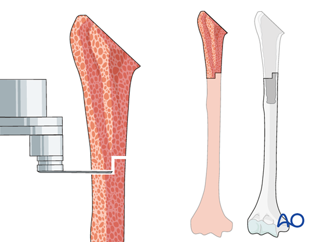 humeral revision with allograft