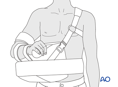 Nonoperative treatment for Humeral implant stable, good bone