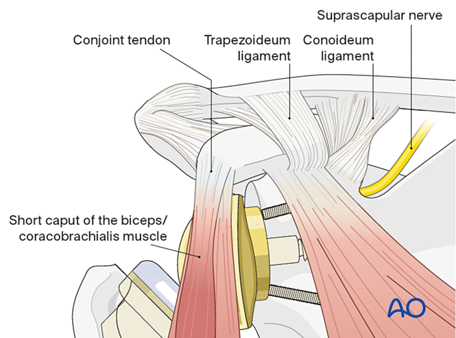 ORIF - Lag screw fixation for Avulsion of the coracoid process