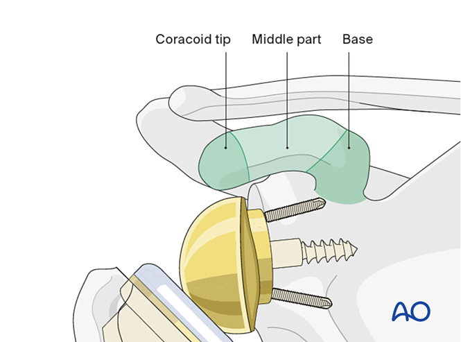 ORIF - Lag screw fixation for Avulsion of the coracoid process
