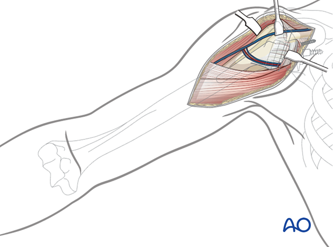 ORIF - Lag screw fixation for Avulsion of the coracoid process