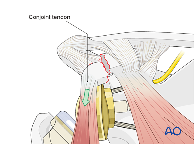 ORIF - Lag screw fixation for Avulsion of the coracoid process