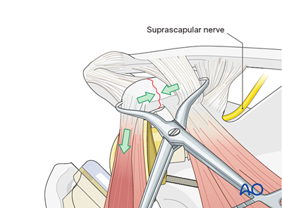 ORIF - Lag screw fixation for Avulsion of the coracoid process