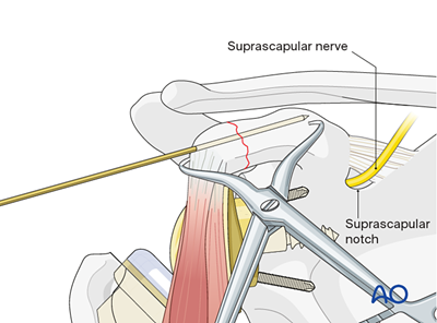 ORIF - Lag screw fixation for Avulsion of the coracoid process