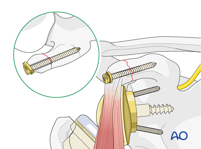 ORIF - Lag screw fixation for Avulsion of the coracoid process