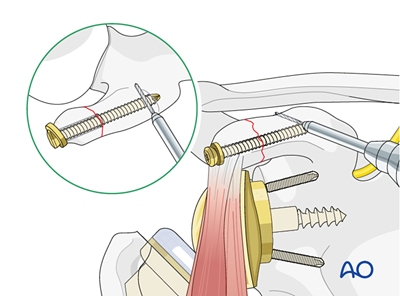 ORIF - Lag screw fixation for Avulsion of the coracoid process