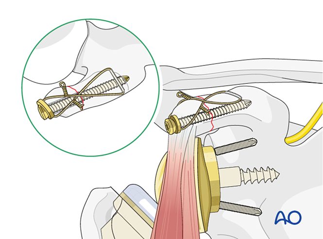 ORIF - Lag screw fixation for Avulsion of the coracoid process