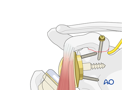 ORIF - Lag screw fixation for Avulsion of the coracoid process
