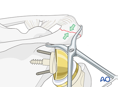 ORIF - Lag screw fixation for Avulsion of the acromion